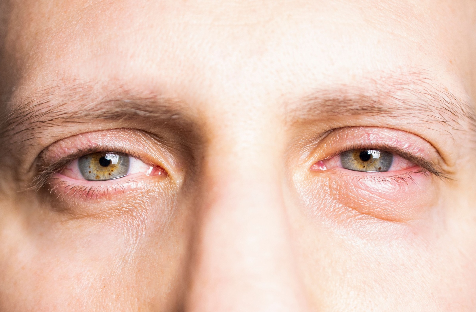 Why Is My Eyelid Swollen & Hurts When I Blink?